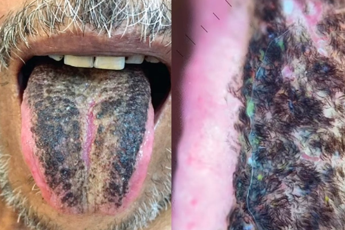 man-s-tongue-turns-black-and-hairy-after-suffering-stroke-the