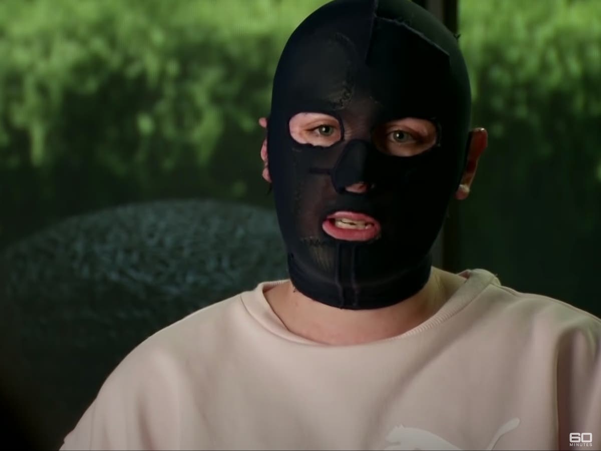 Australia woman who suffered third-degree burns from New Zealand ...