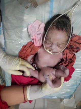 Polymelia: Indian baby born with four arms and four legs hailed a ...