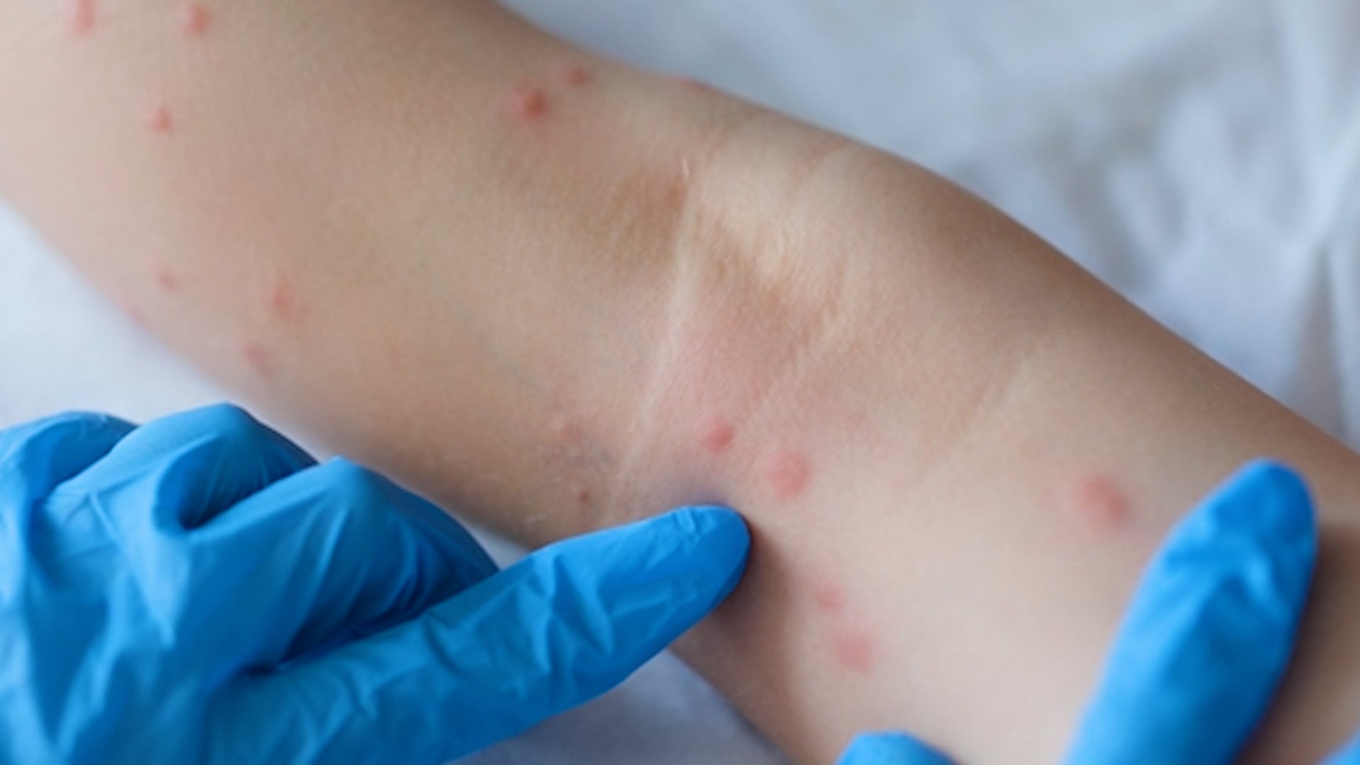 Smallpox has plagued humans since ancient Egyptian times, scientists ...