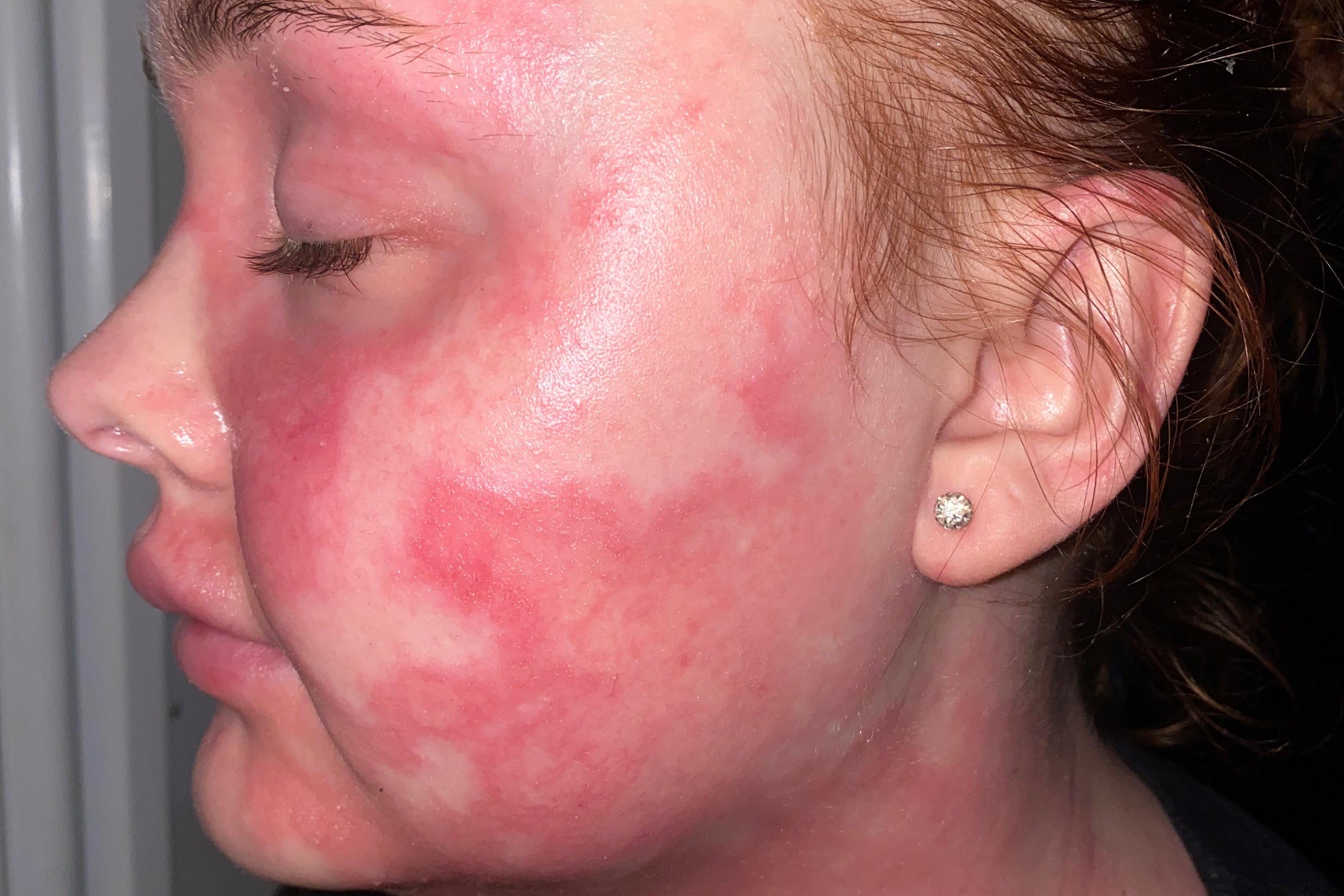 Woman With Eczema Left Housebound In searing Pain After Face Started Woman With Eczema Left Housebound In searing Pain After Face Started