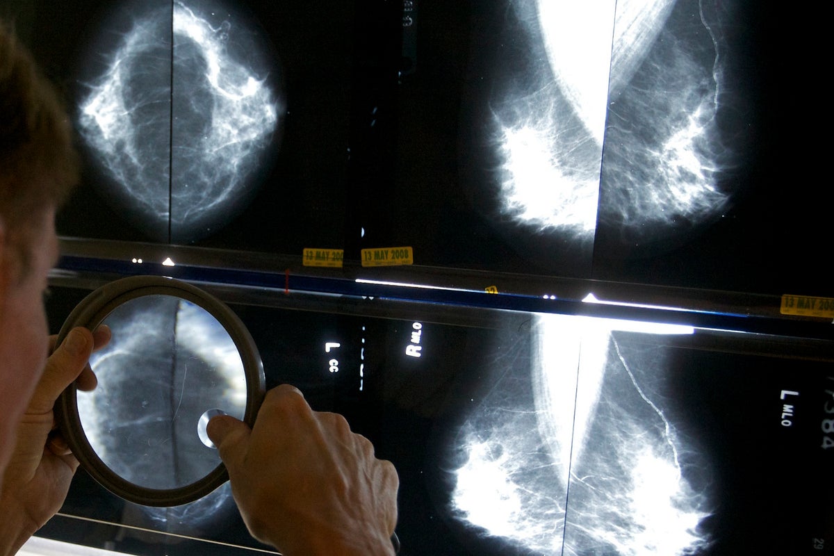 US requires new info on breast density with all mammograms | The Independent