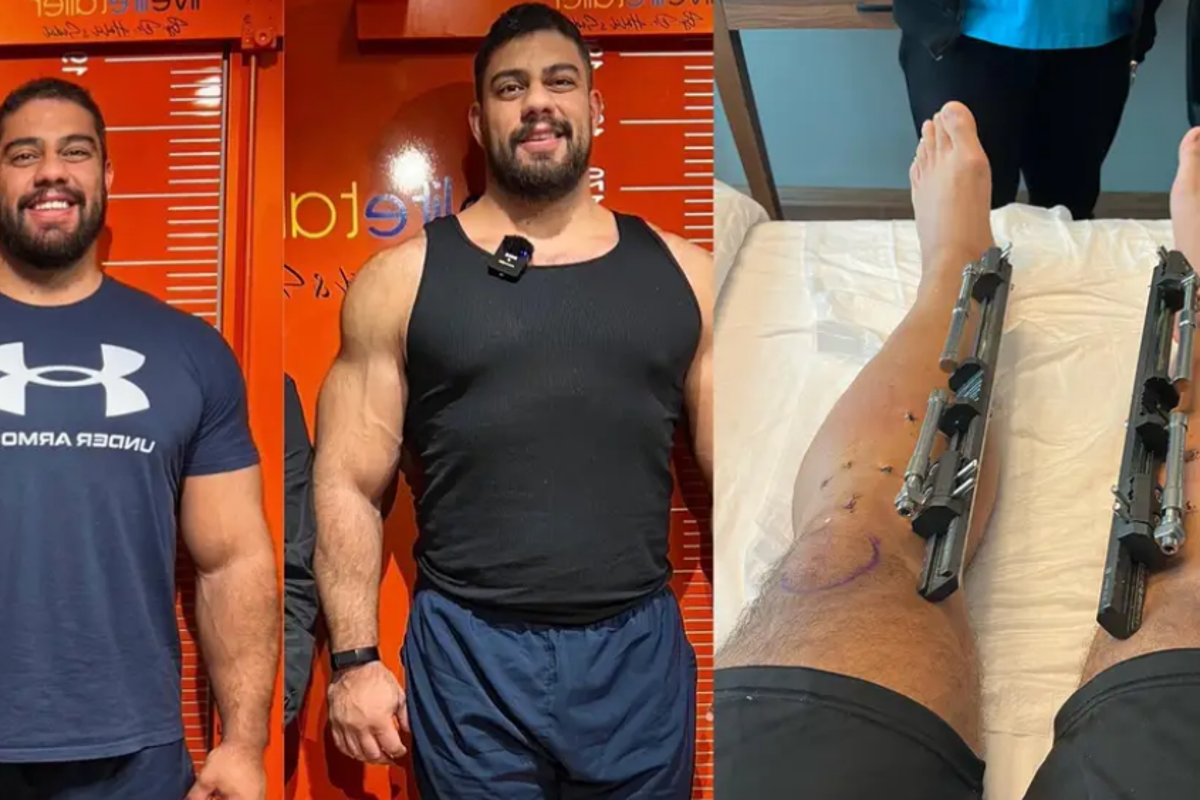 Turkey leg lengthening surgery: Georgia man has £86,000 surgery to make ...
