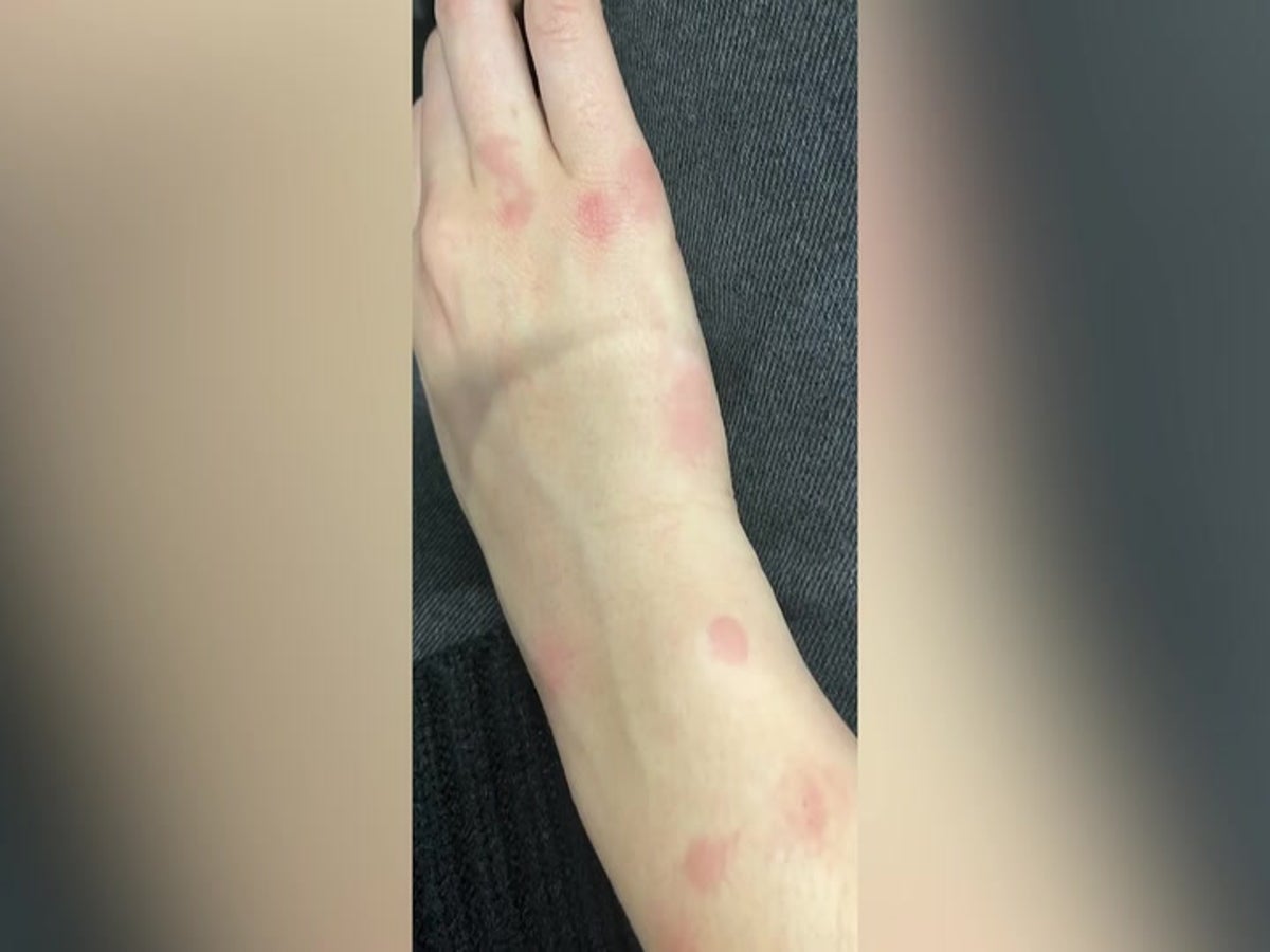 Bedbug Bites On Arm