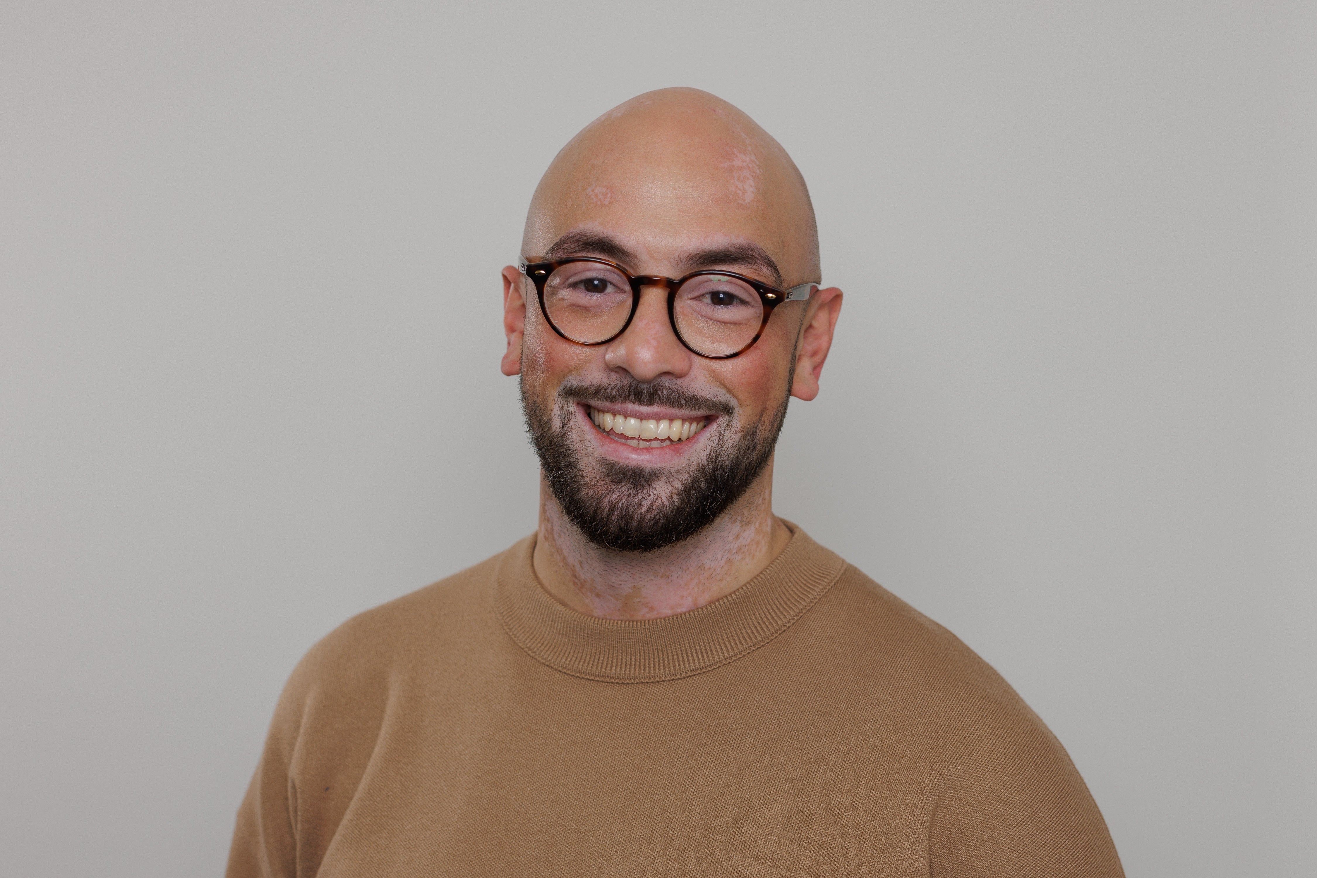 Men with vitiligo: I have worn make-up since 14 - not because of vanity ...