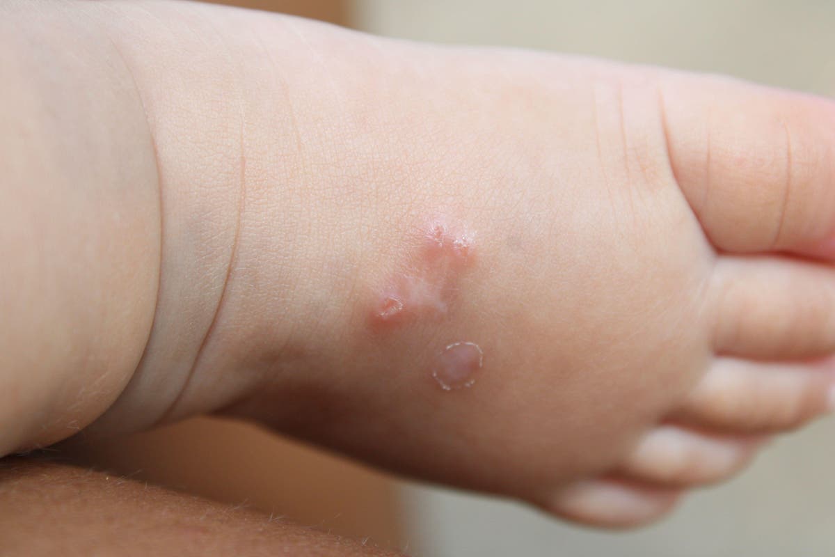 What is scabies and how do you get it? | The Independent