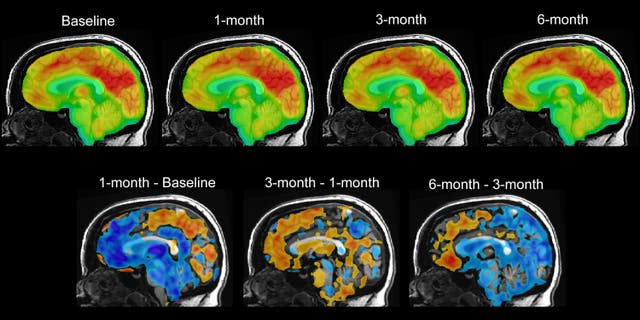 The pacemaker for the brain that could finally cure depression | The ...