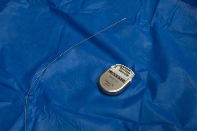 The pacemaker for the brain that could finally cure depression | The ...