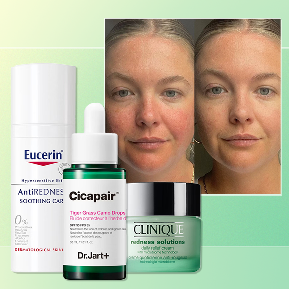 What is rosacea and how can you treat it? | The Independent