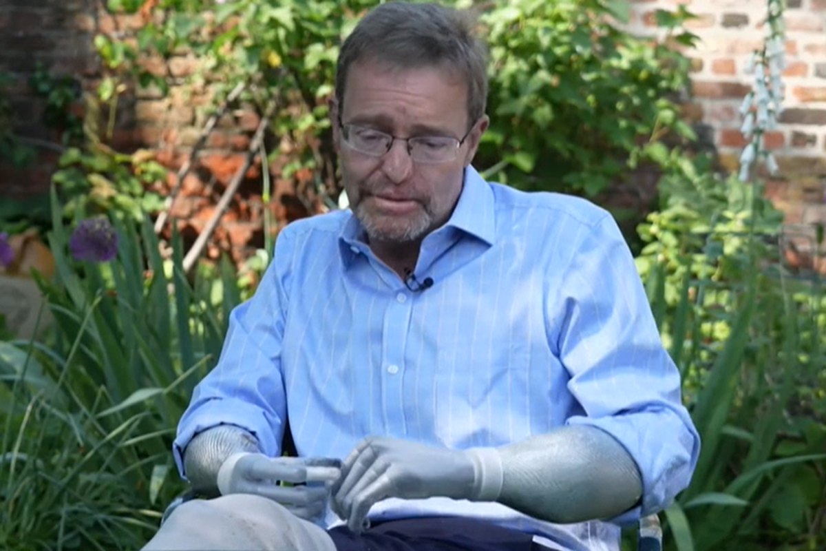 Craig Mackinlay reveals his limbs were amputated after contracting ...