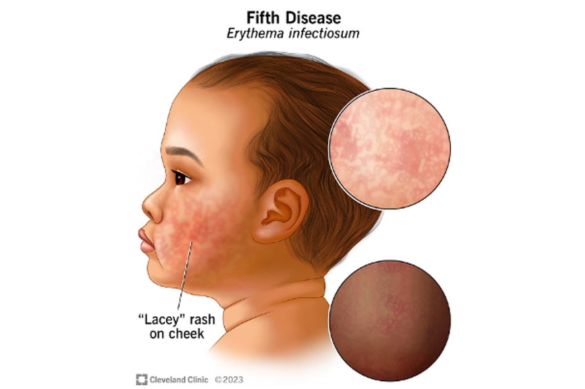 Parvovirus: ‘Slapped cheek’ rash-causing virus on the rise among kids ...