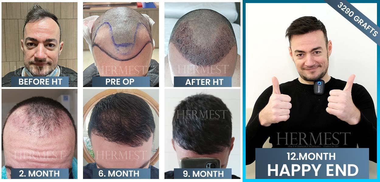 Comprehensive guide to the best hair transplant process in Turkey | The ...