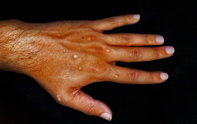 Mpox symptoms explained: From painful skin rash and blisters to fever ...