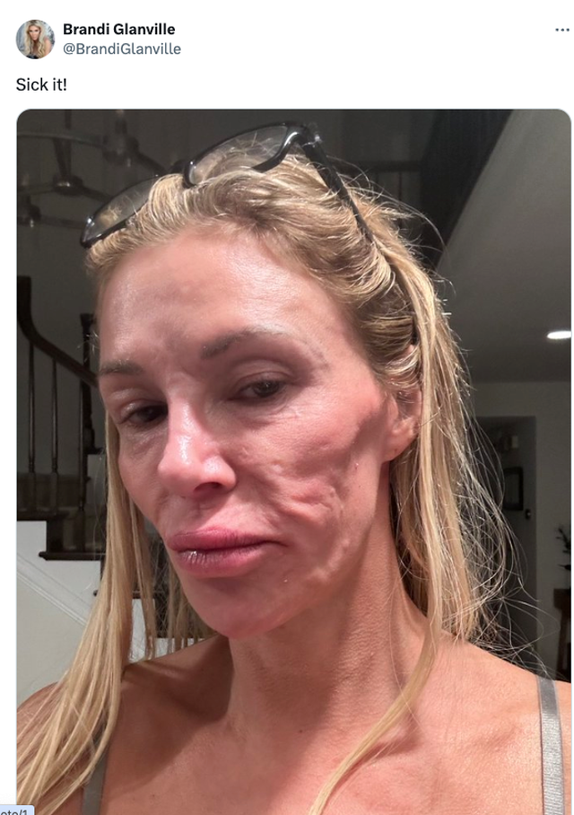 Brandi Glanville shares health update after learning cause of facial ...