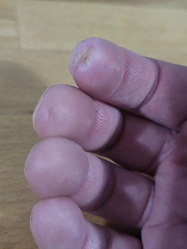 Scleroderma: Dad given two years to live after cold fingers turns out ...