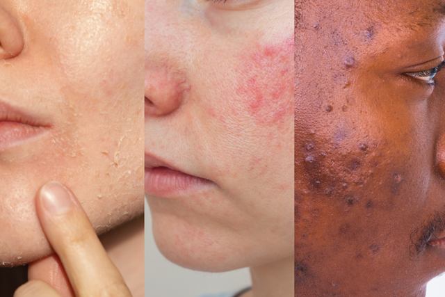 How to repair the skin barrier: Products and tips from a dermatologist ...