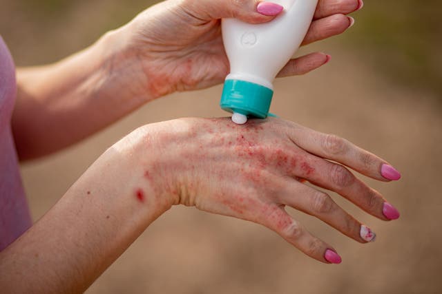 How to spot, treat and prevent scabies, according to the experts | The ...