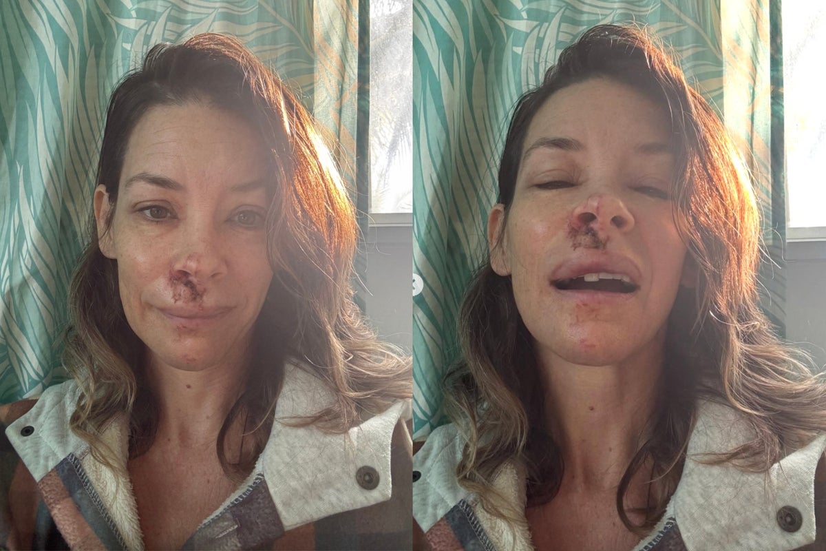 Lost star Evangeline Lilly shows off bloody facial injuries after ...