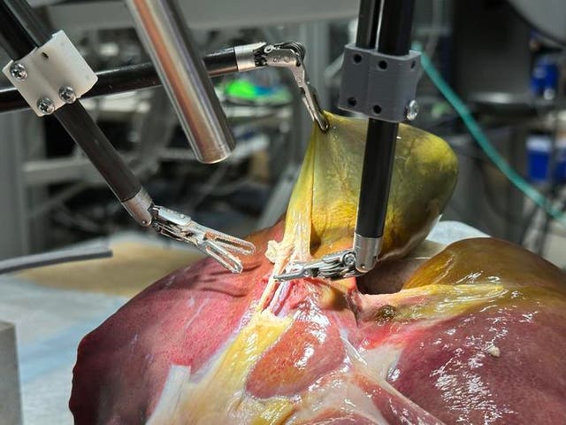 <p>Johns Hopkins University researchers said Wednesday that the Surgical Robot Transformer-Hierarchy had trained on videos to conduct a lengthy phase of a gallbladder removal on a lifelike patient</p>