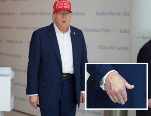 Trump reveals dark bruising on hand as he goes cover-up-free in Oval ...