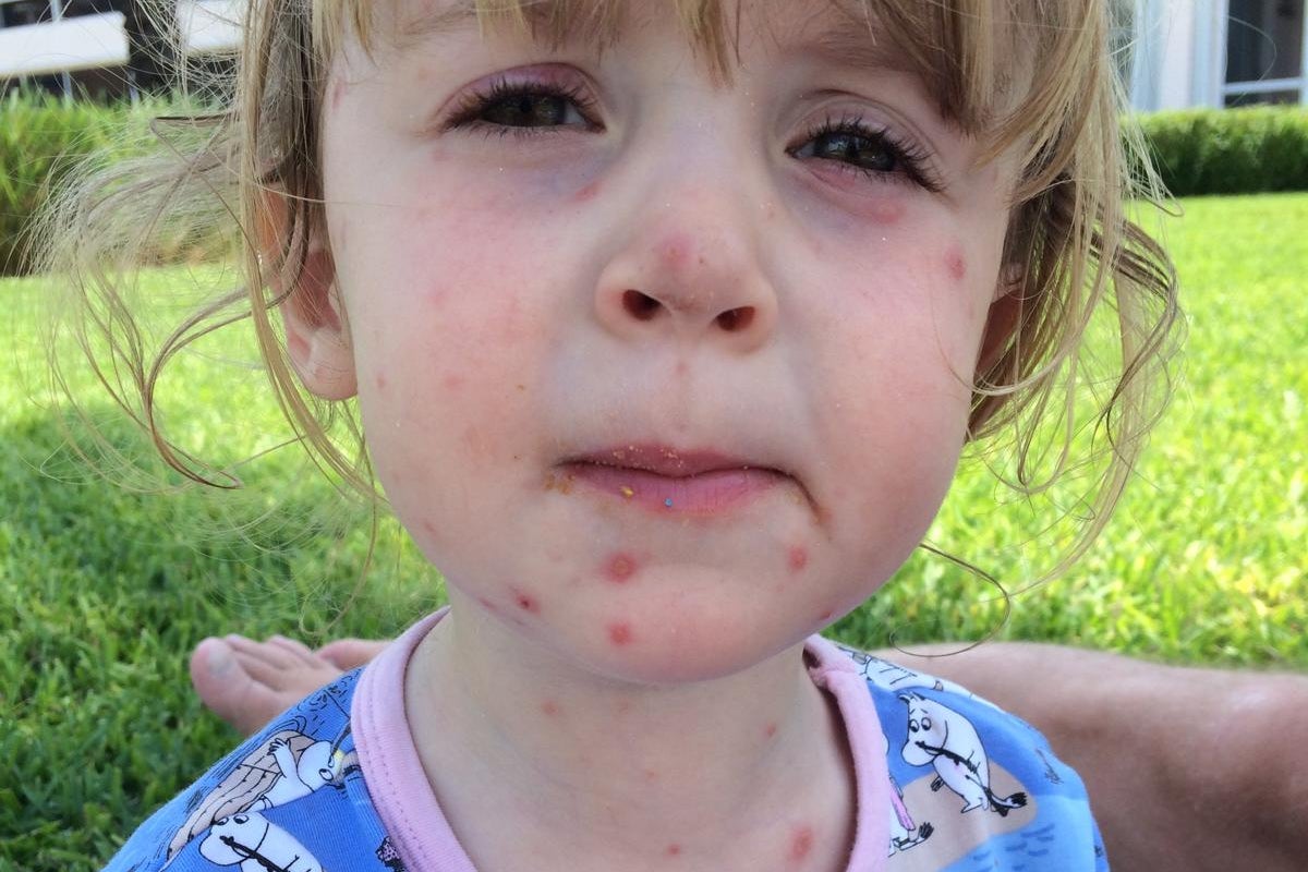 Chicken Pox On Toddlers Face