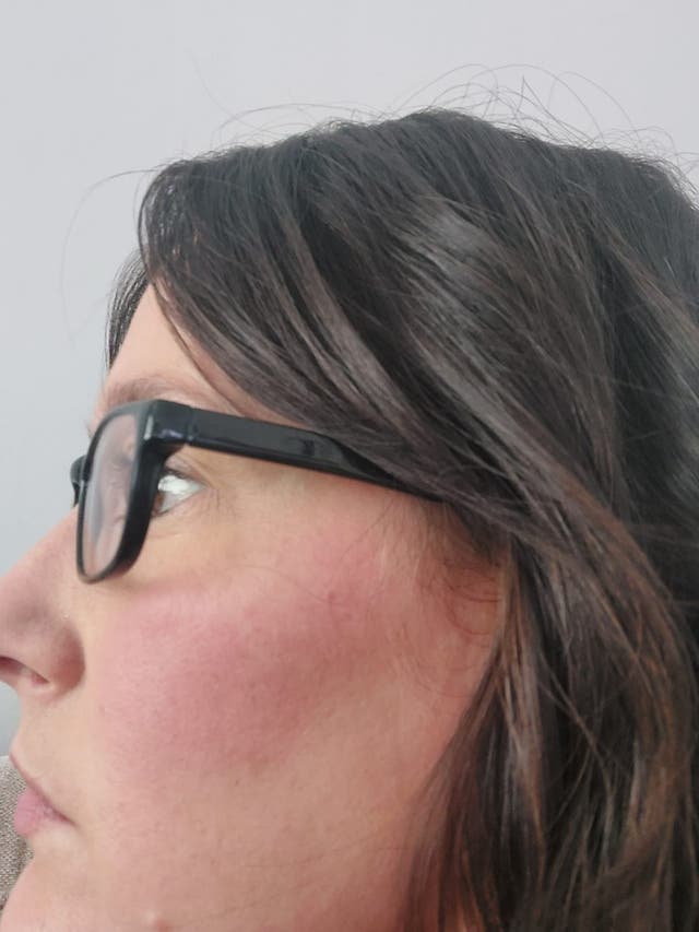 Cold urticaria: Symptoms of the cold allergy include hives and trouble ...