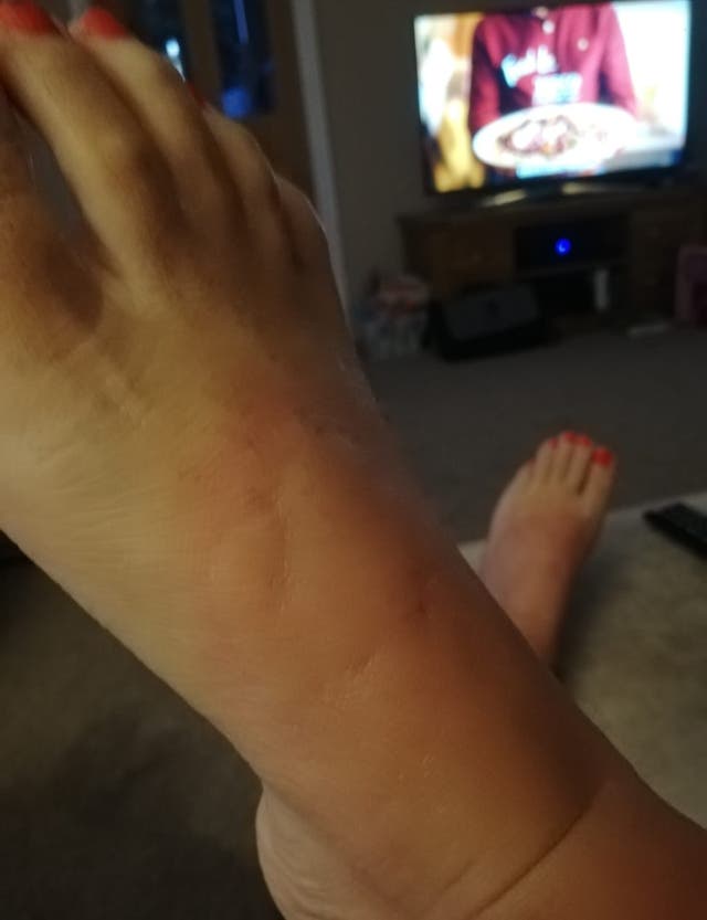 Cold urticaria: Symptoms of the cold allergy include hives and trouble ...