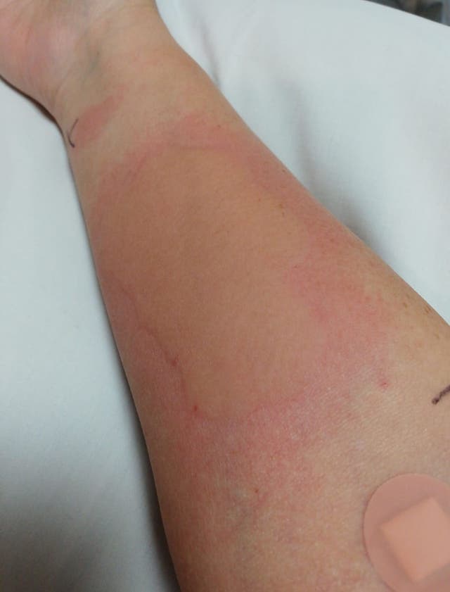 Cold urticaria: Symptoms of the cold allergy include hives and trouble ...