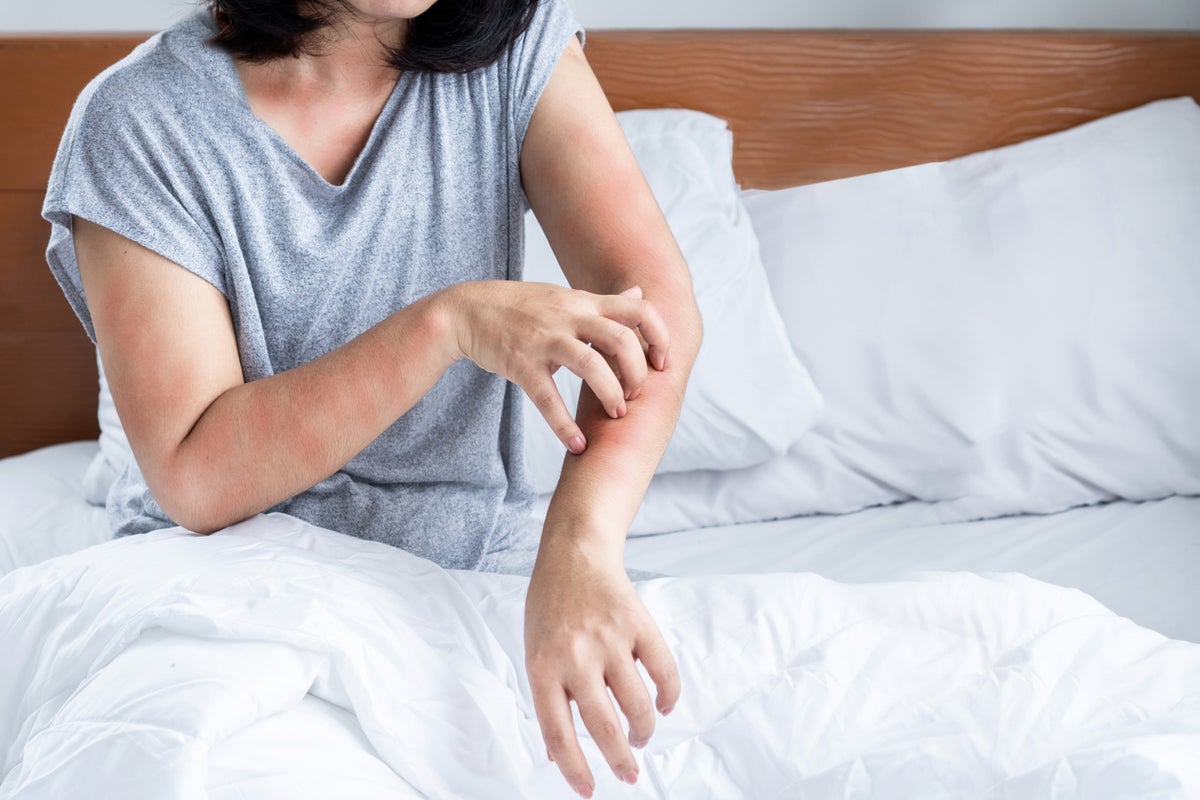 US sees surge in sexually transmitted ringworm | The Independent