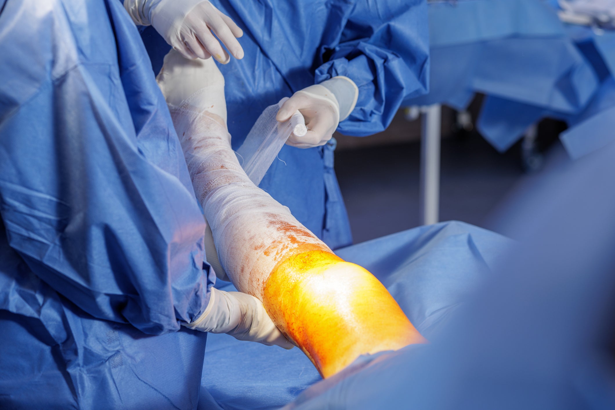 More Brits going abroad for leg-lengthening surgery in bid to get ...