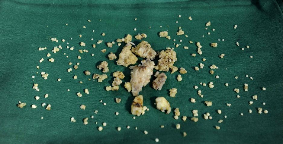 Indian boy has 232 teeth removed from his mouth (really) | indy100 ...