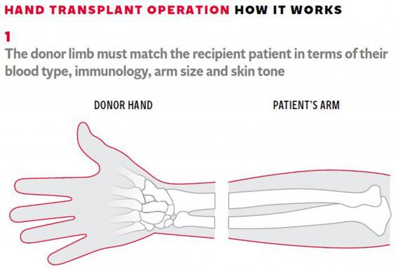 NHS patients to receive first hand and arm transplants | The Independent