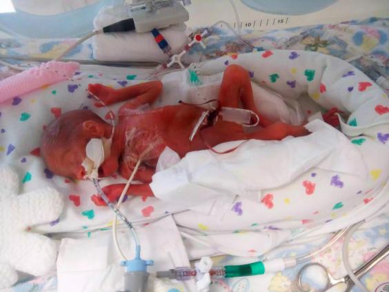 Mother reveals how her premature baby was born with red skin so ...