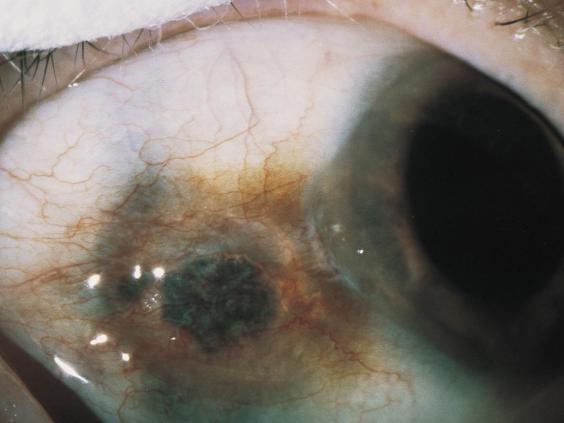 Brexit could harm my sons’ access to treatment for rare ‘black bone ...