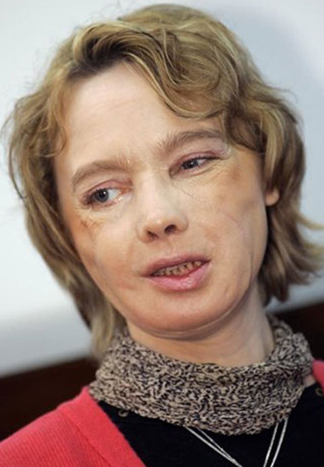Face transplant recipient Isabelle Dinoire faces the world | The ...