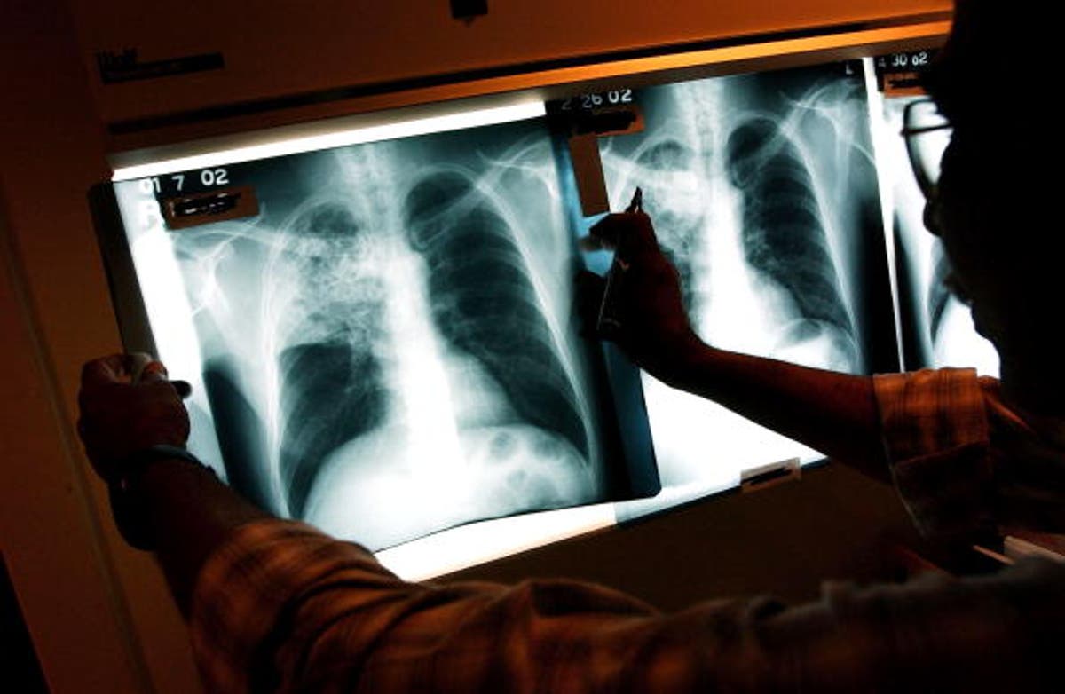 The facts about TB | The Independent | The Independent