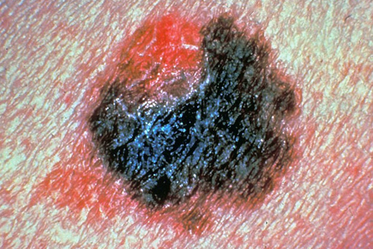 Scientists hail the first effective treatment for skin cancer victims ...