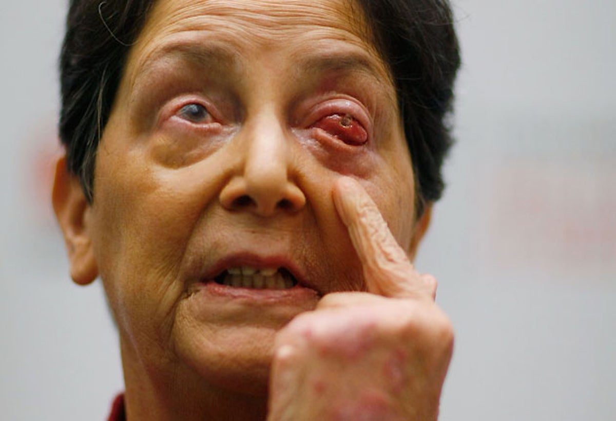 tooth implanted eye prosthesis