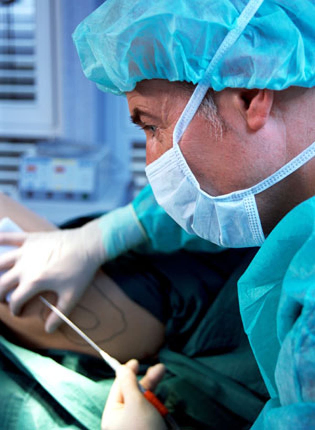 Fat removed by liposuction returns after a year, study finds | The ...