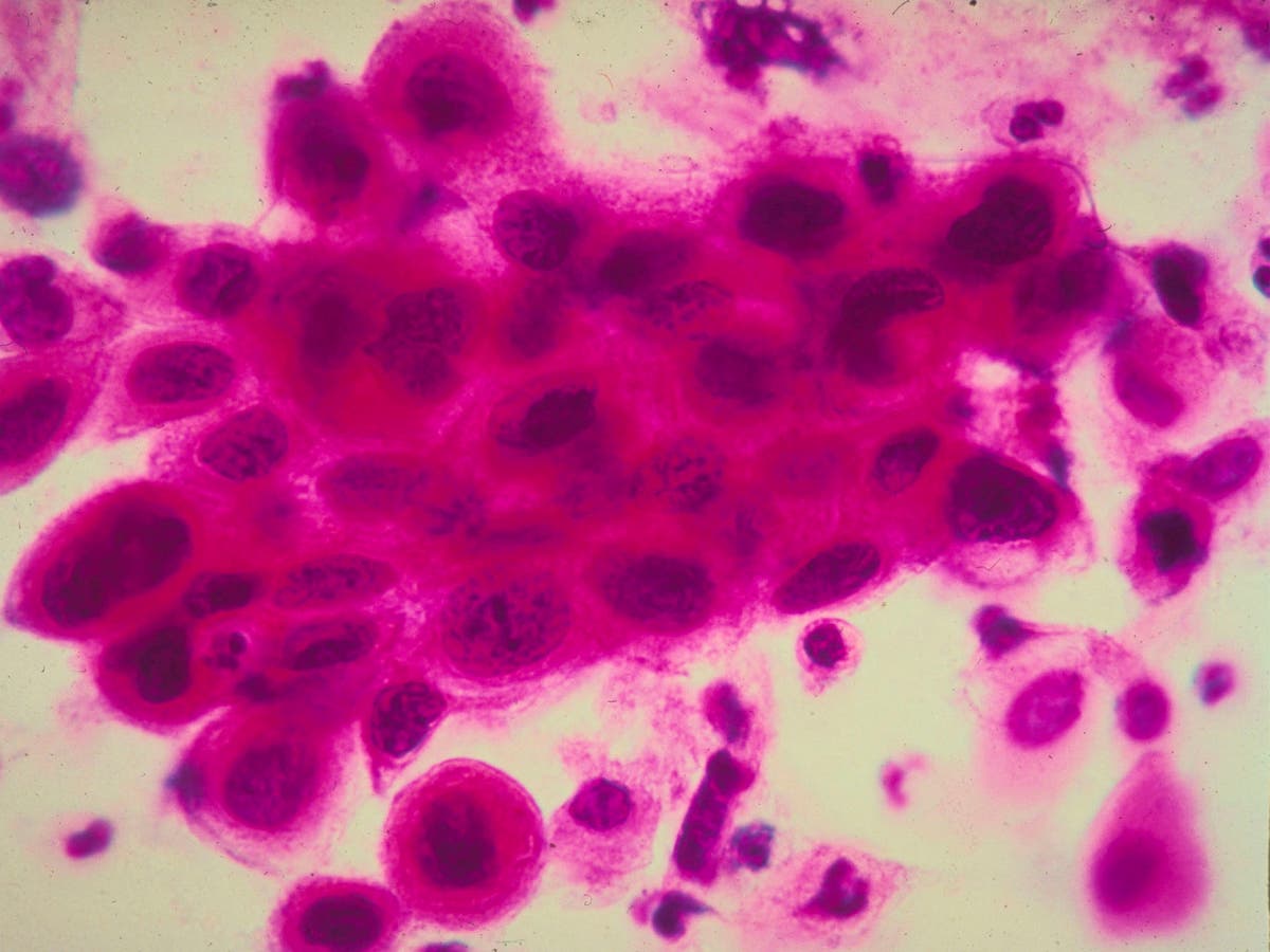 Cells from patients' own blood spur cancer remissions | The Independent ...