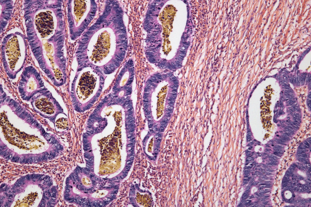 Fungal toenail drug able to eliminate sleeping bowel cancer cells ...