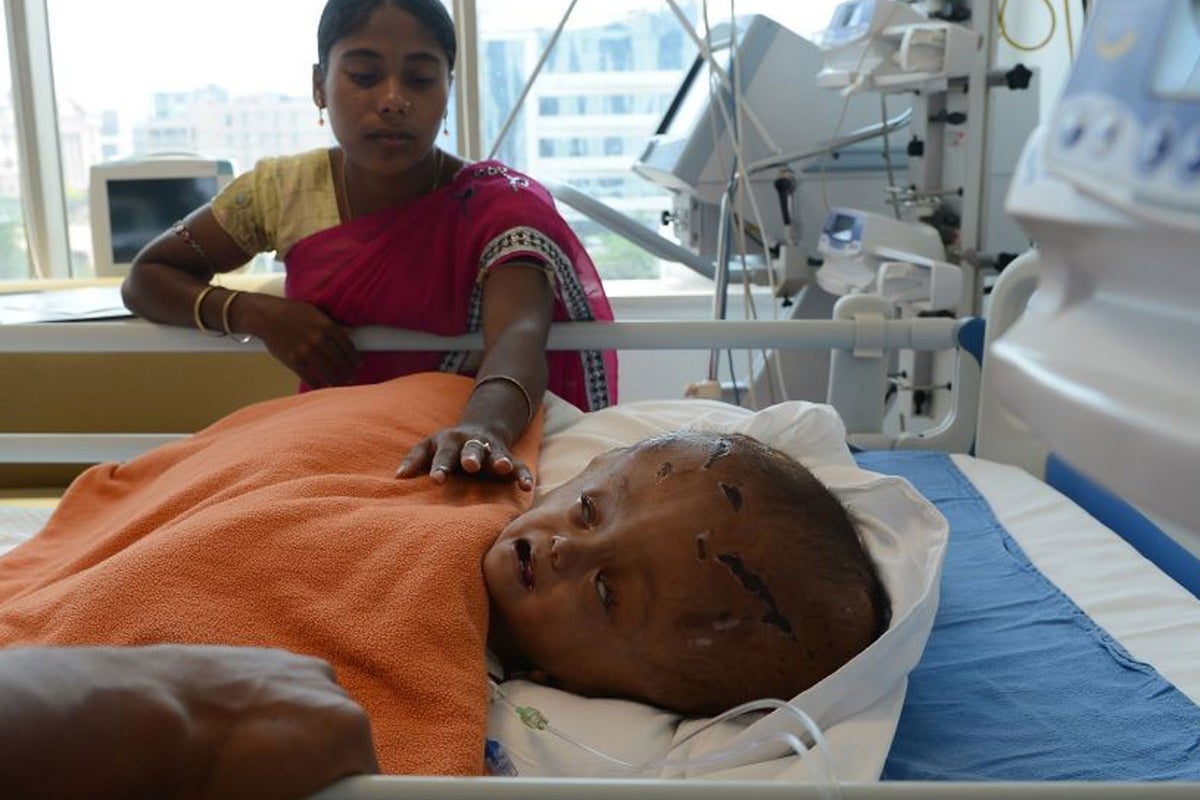 Roona Begum - the Indian girl whose head had swollen to twice its usual ...