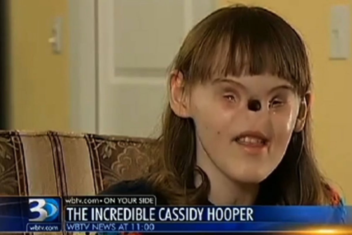Teenager Cassidy Hooper born without a nose or eyes undergoes ...