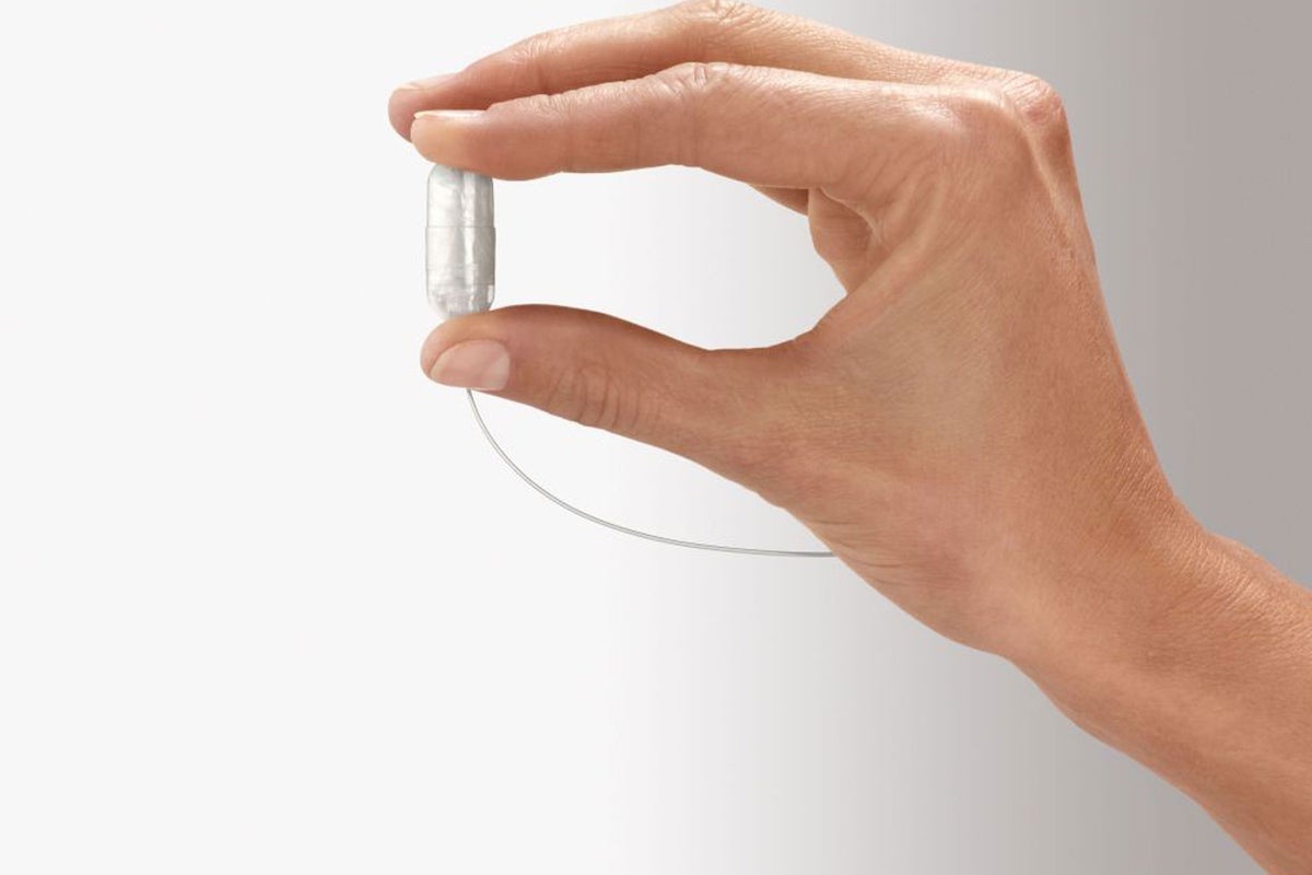 Obalon gastric weight loss pill which releases a balloon in patients ...