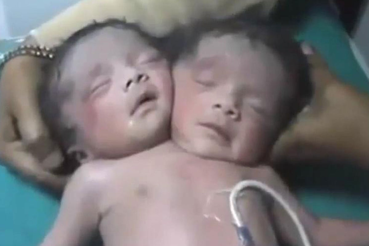 Woman in India gives birth to 'two-headed baby' | The Independent | The ...