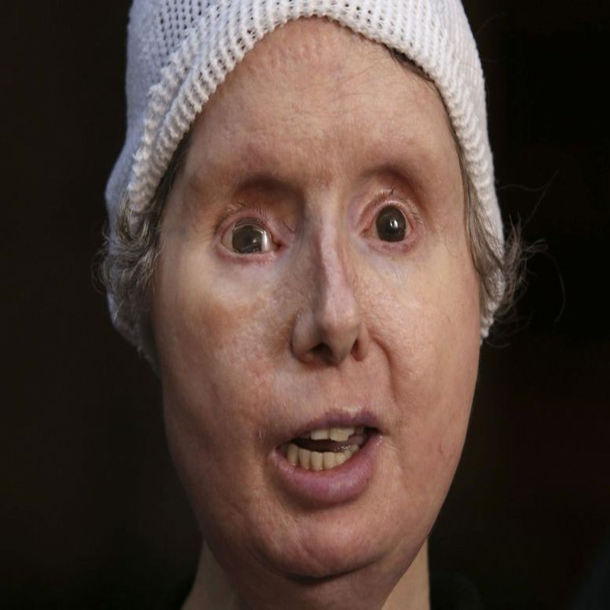 Charla Nash Woman Had Face And Hands Ripped Off By Pet Chimp Who 'ate