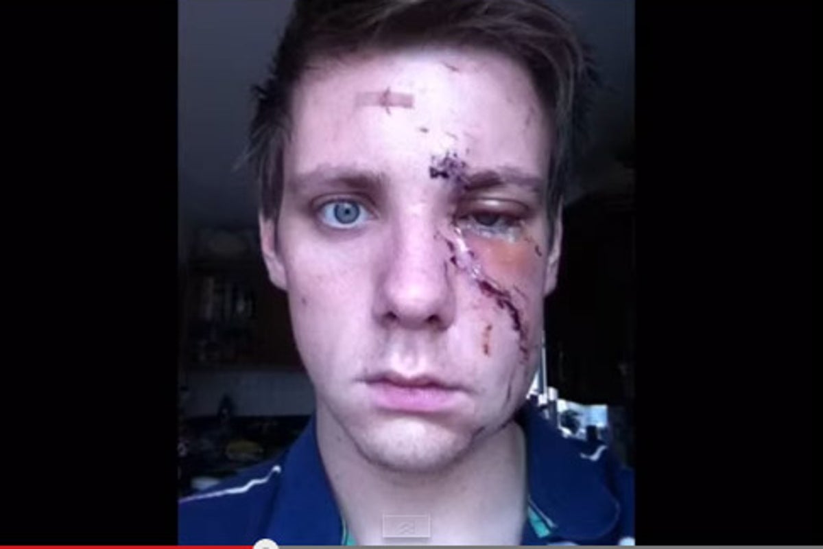 Video: Glass attack victim | The Independent | The Independent