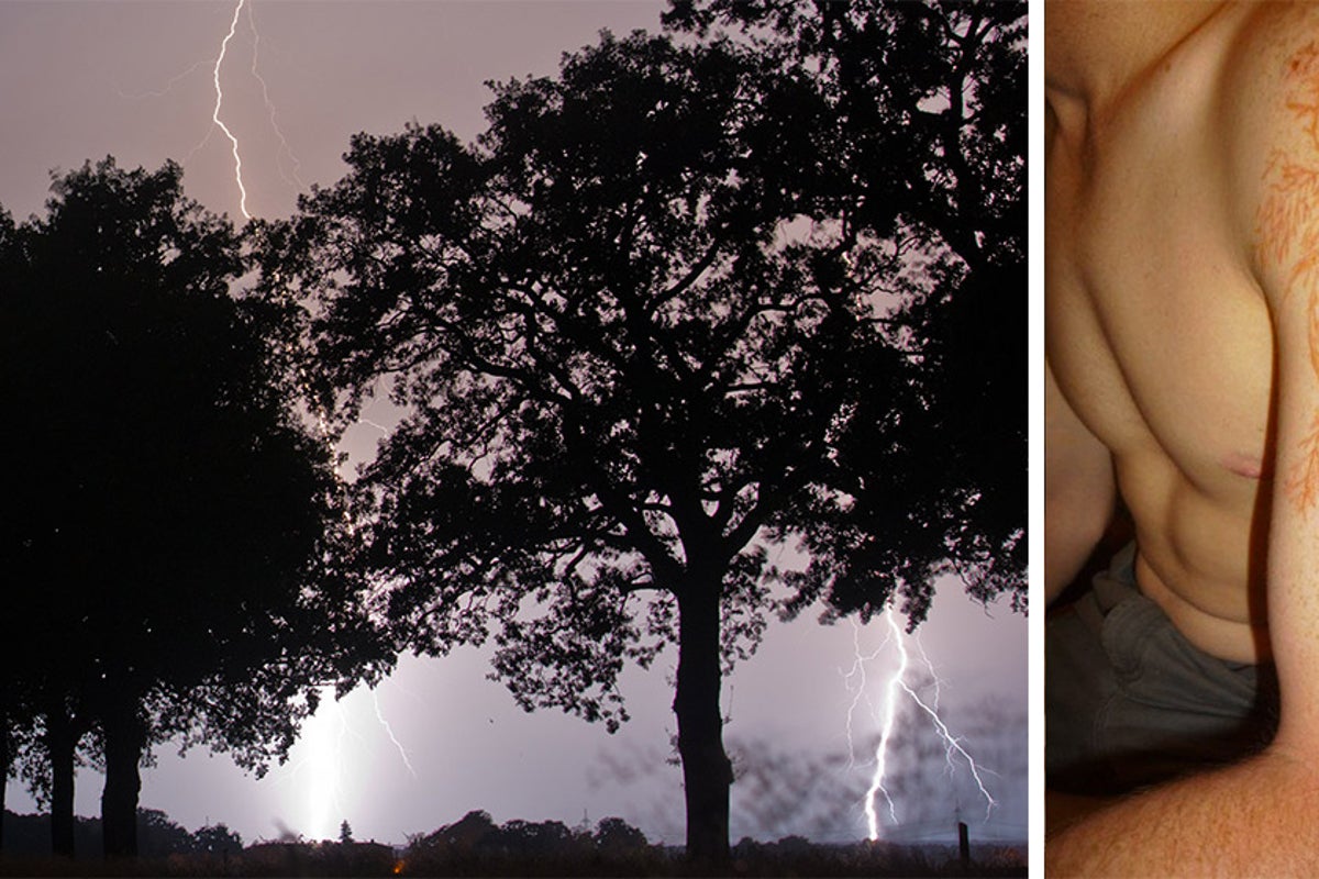 What it's like to be struck by lightning (and survive) | The ...