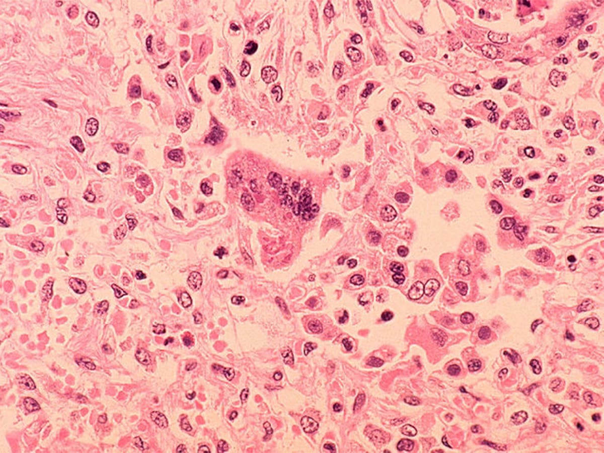 Measles makes its mark all over again: One of humanity's oldest foes is ...