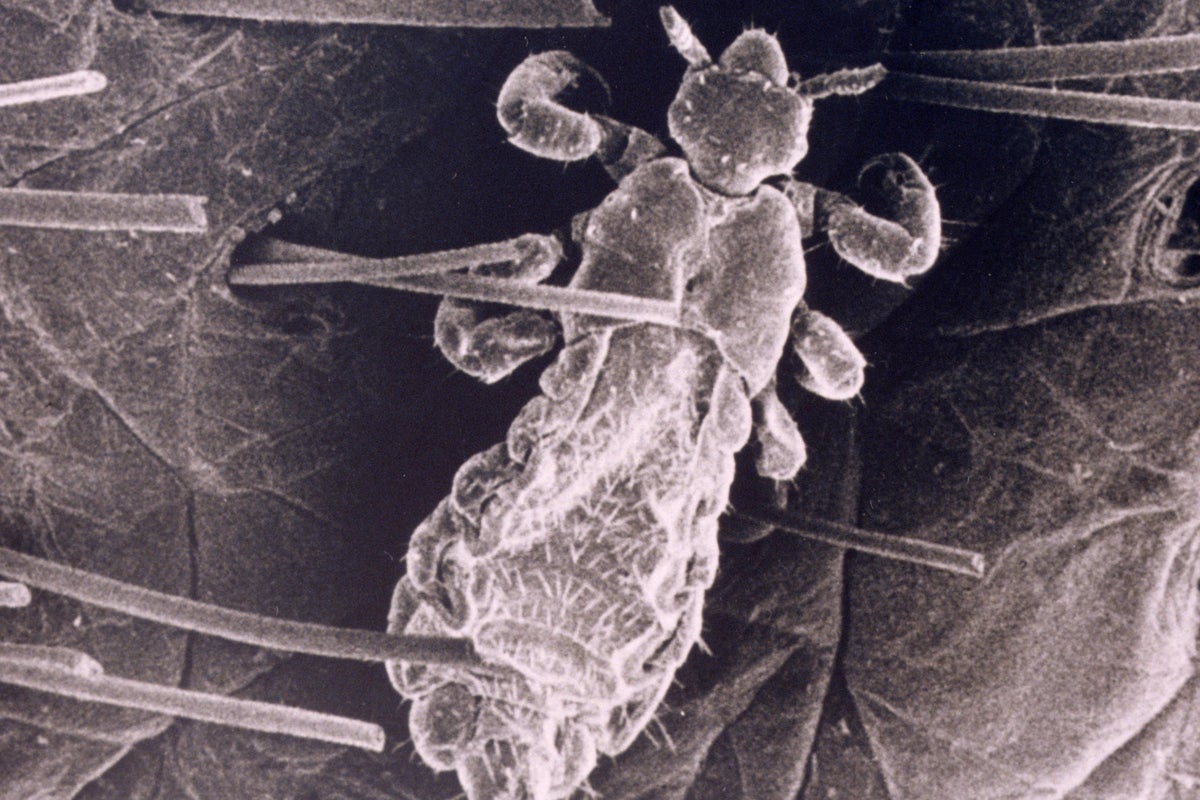 Worst case of head lice ever? grim video shows lice wriggling across ...
